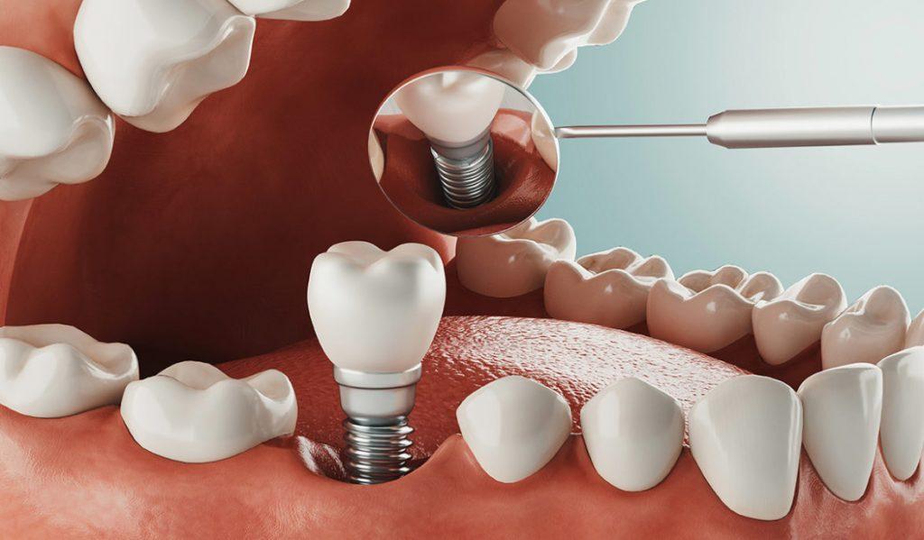 Implants – Baja Endodontics